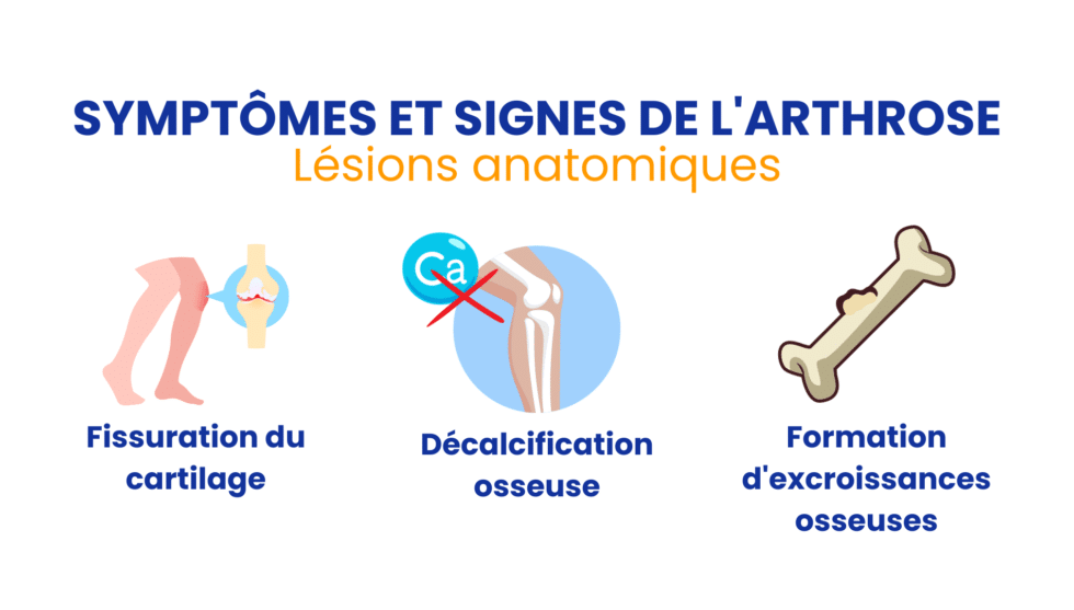 Tout savoir sur l'Arthrose : Comprendre, agir et prévenir - Yvery