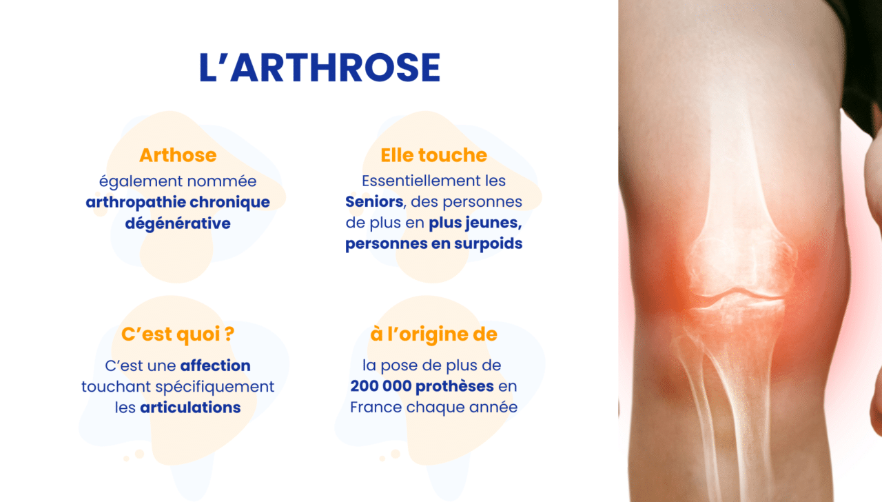 Tout savoir sur l'Arthrose : Comprendre, agir et prévenir - Yvery