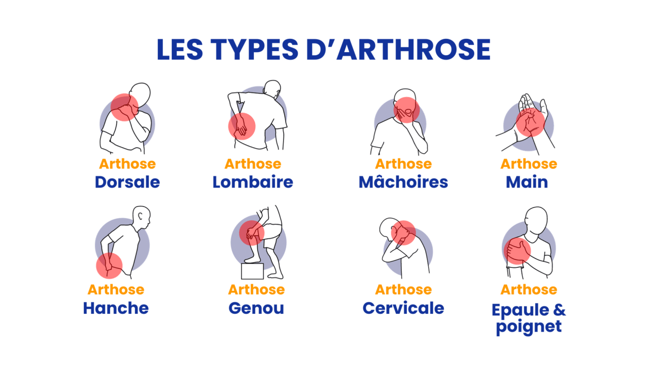 Tout savoir sur l'Arthrose : Comprendre, agir et prévenir - Yvery